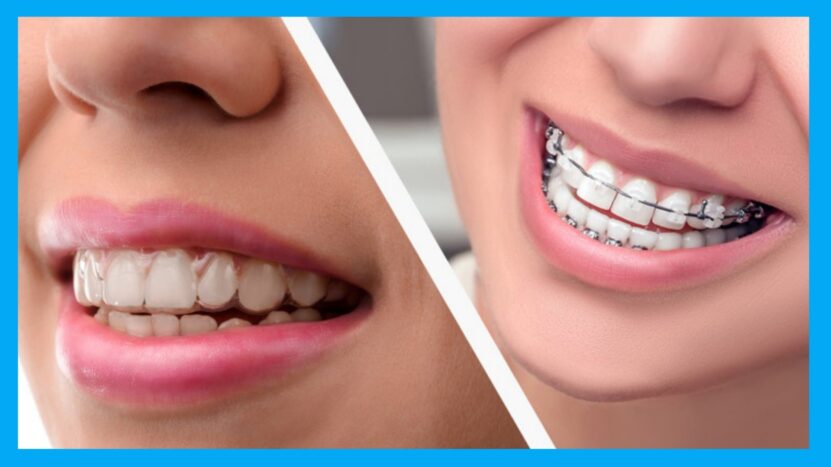 The Cost of Invisalign: Understanding the Investment in Your Smile ...